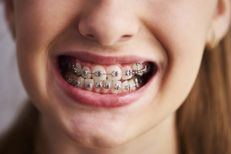 Braces Again? - E&S Orthodontics