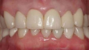What Is Gingival Contouring?