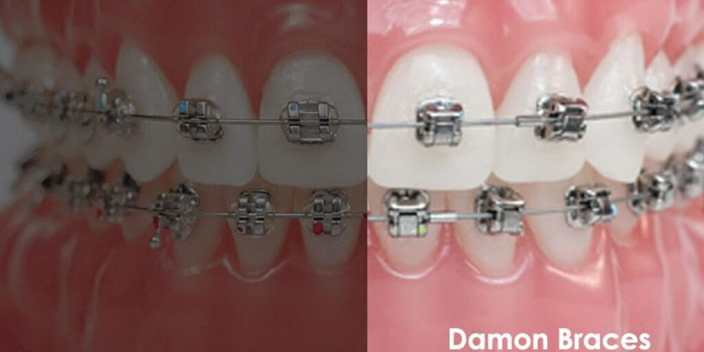 Damon Braces vs Traditional Braces